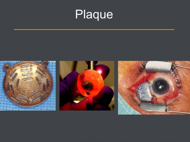 Plaque Radiotherapy for Uveal Melanoma | PPTX