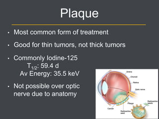 Plaque Radiotherapy for Uveal Melanoma | PPTX