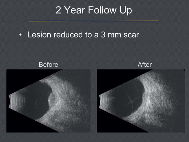 Plaque Radiotherapy for Uveal Melanoma | PPTX