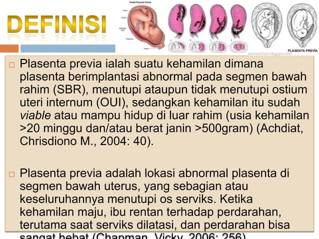 Plasenta previa | PPTX
