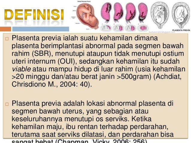 Plasenta previa