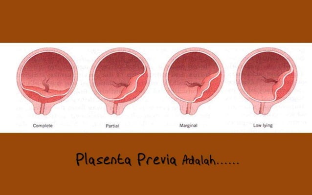 Plasenta previa | PPTX