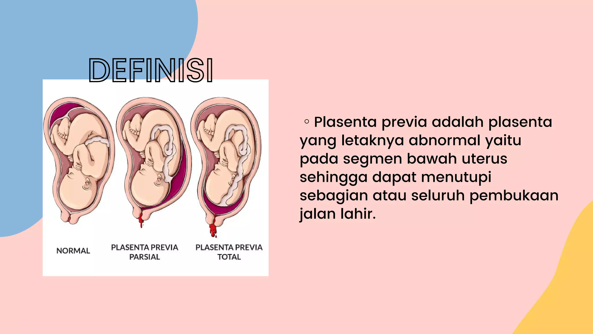 plasenta previa .pdf