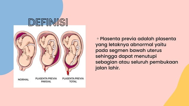 plasenta previa .pdf