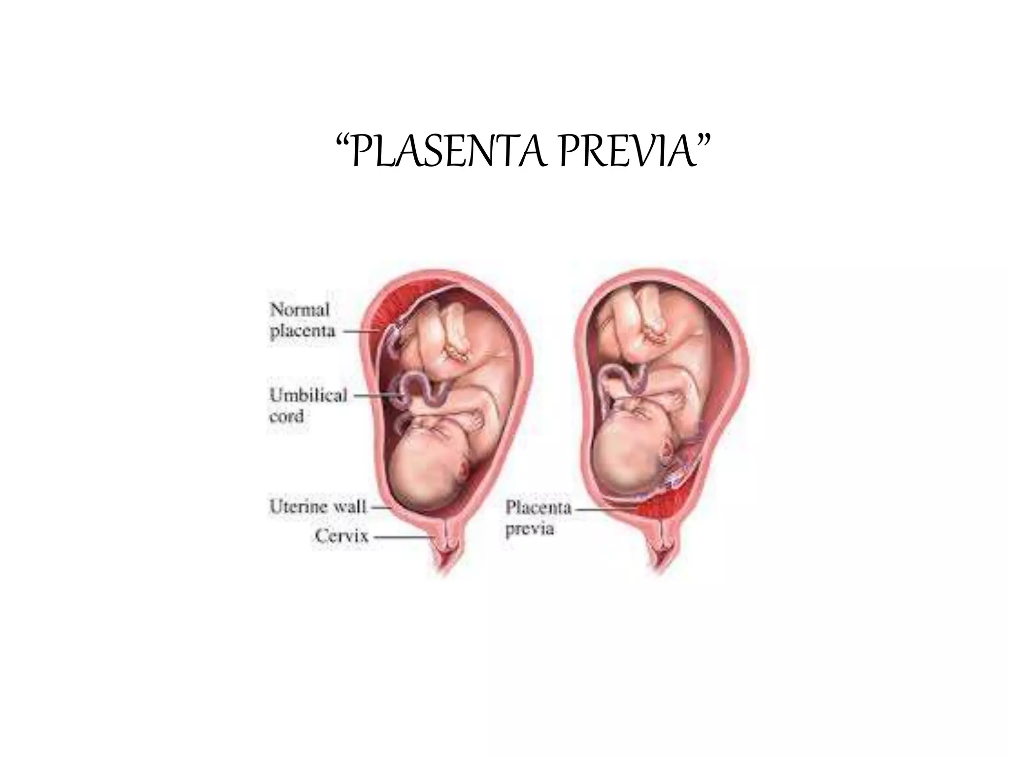 Plasenta previa (2) | PPTX