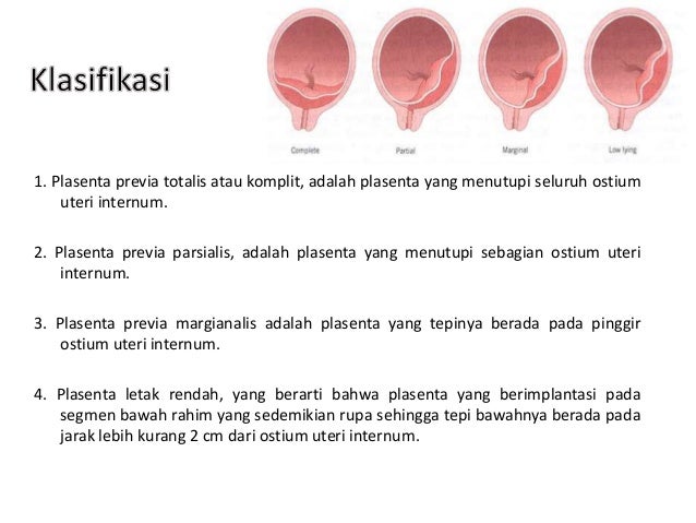 Plasenta previa (2)