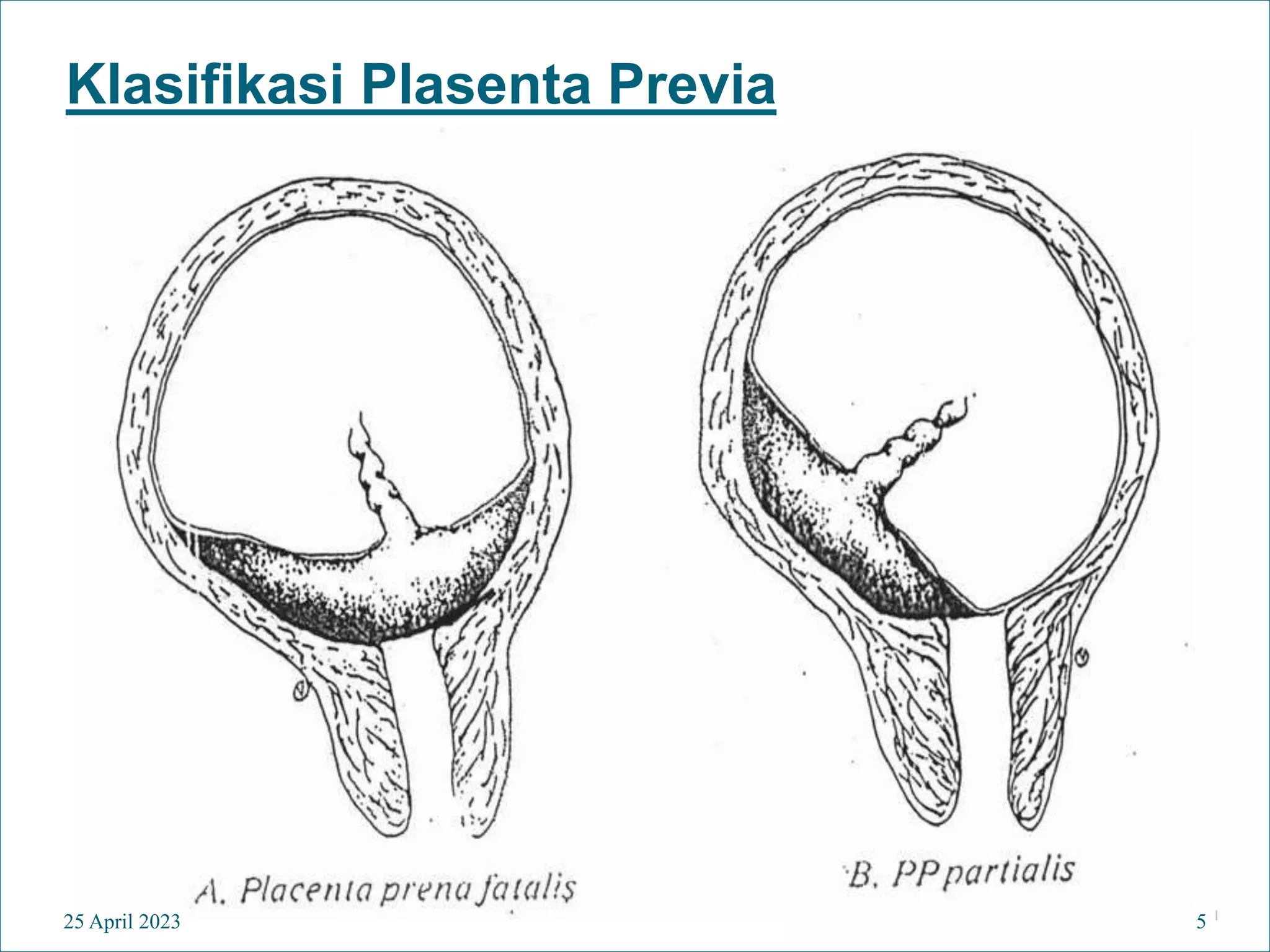 Plasenta_Previa_and_Sol_Plasenta idri.pptx