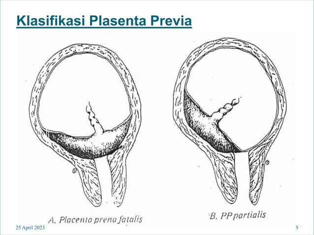 Plasenta_Previa_and_Sol_Plasenta idri.pptx