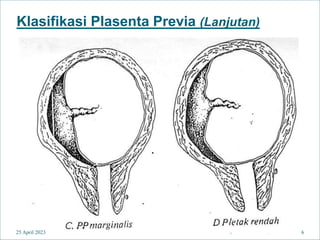 Plasenta_Previa_and_Sol_Plasenta idri.pptx