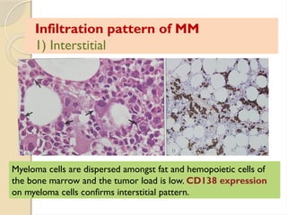 plasma cell disorders in pathology as per WHO | PPTX