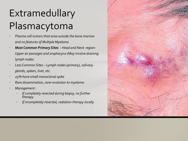 Plasma cell disorders ppt | PPT