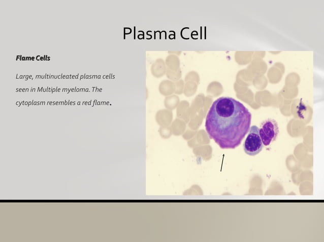 Plasma cell disorders ppt | PPT