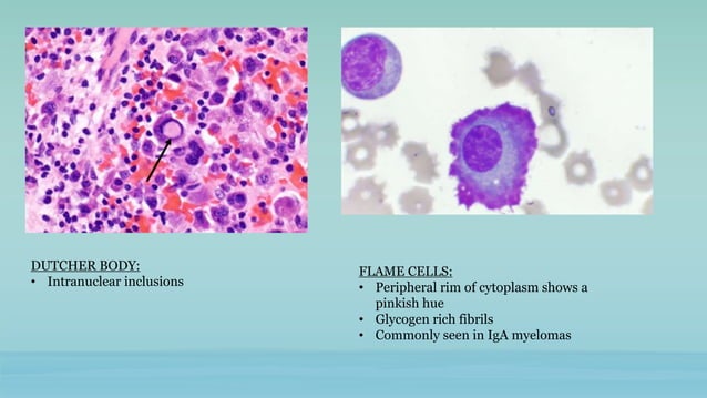 PLASMA CELL DYSCRASIAS Overview.....pptx