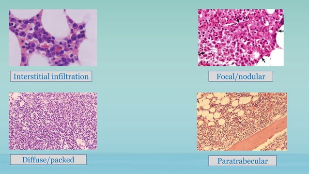 PLASMA CELL DYSCRASIAS Overview.....pptx