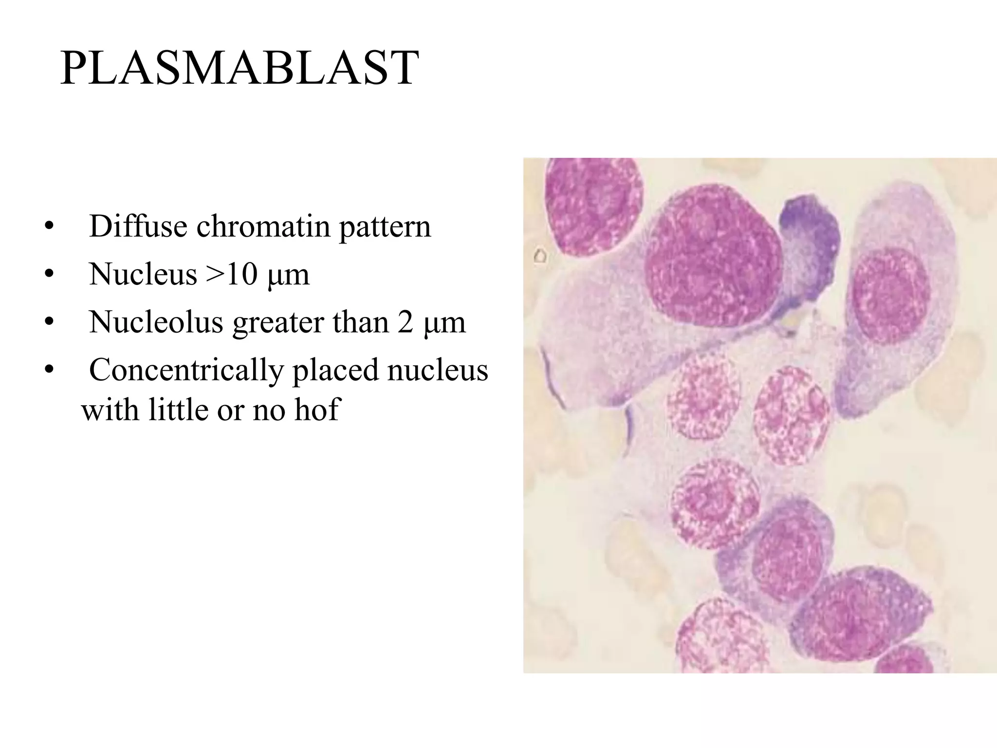 Plasma cell dyscrasias | PPTX