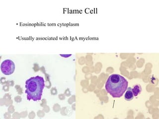 Plasma cell dyscrasias | PPTX