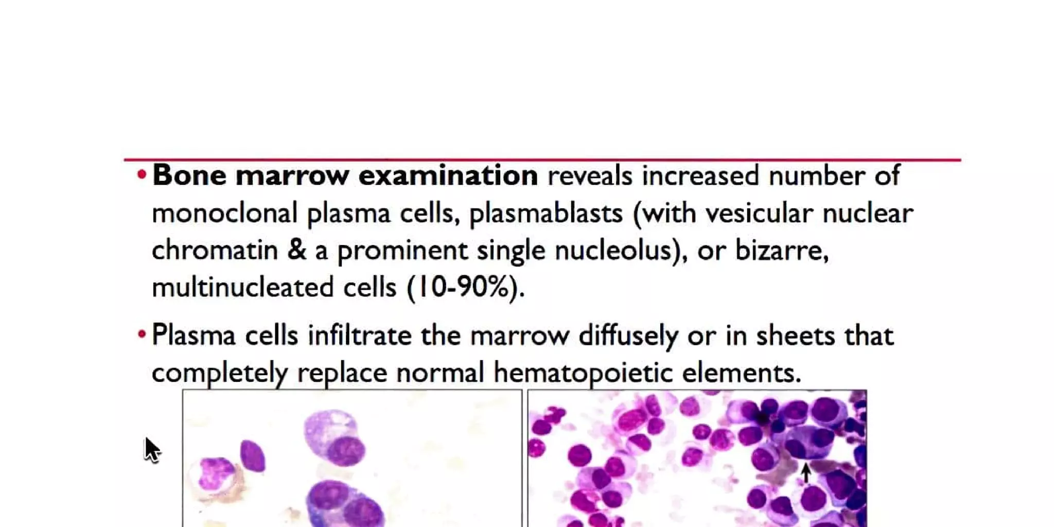 Plasma cell myeloma pathology (1) | PDF