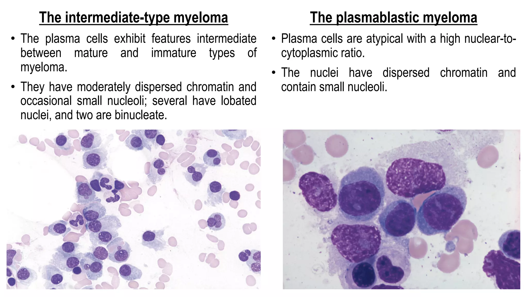 Plasma Cell Neoplasms (2021) | PDF