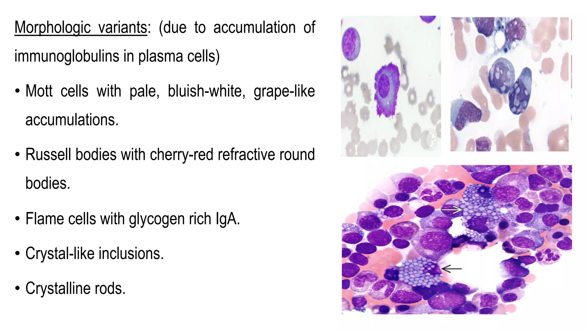 Plasma Cell Neoplasms (2021) | PDF