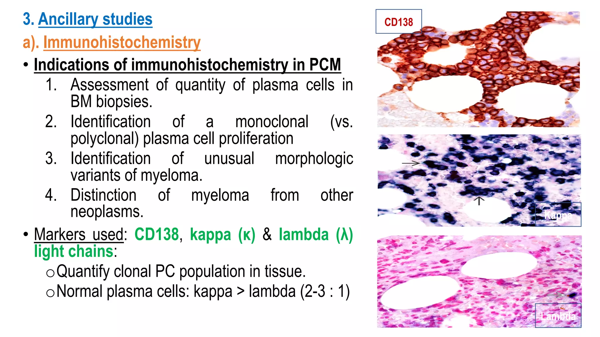 Plasma Cell Neoplasms (2021) | PDF