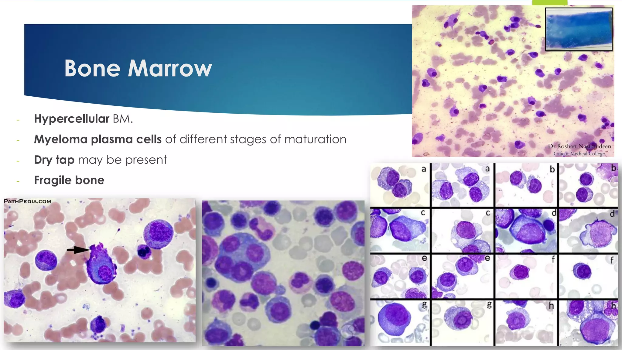Plasma cell Neoplasms 2021.pdf