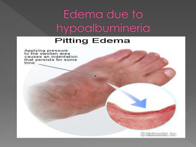 Plasma protein classification 1 albumin | PPTX | Blood Disorders ...