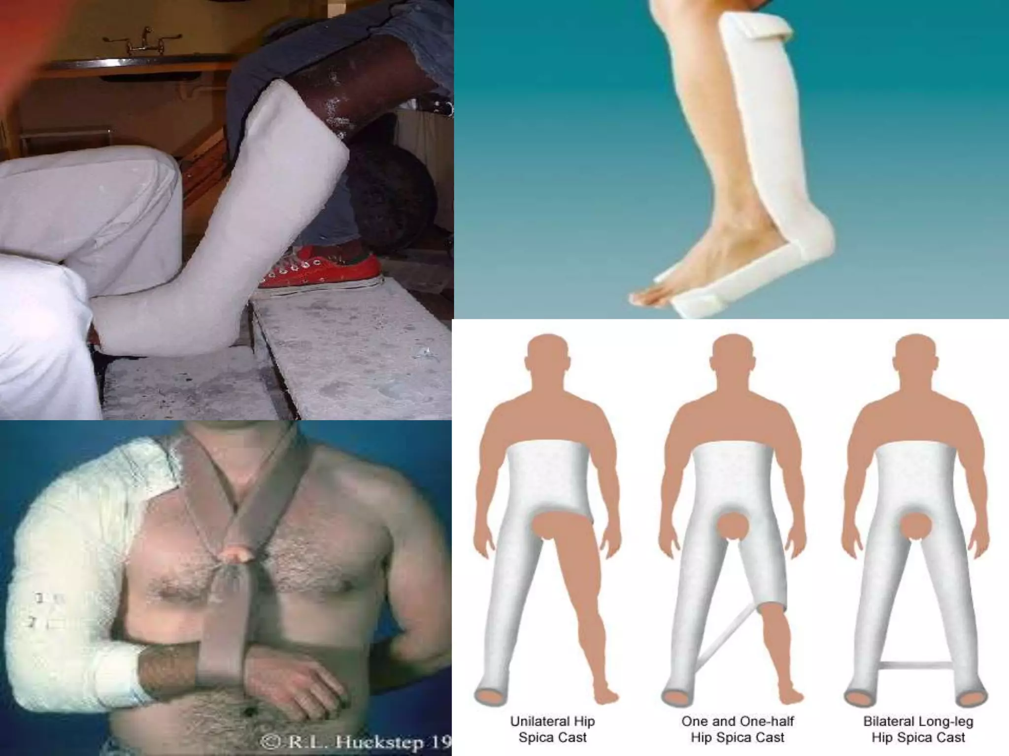 Plaster of Paris and Plaster Technique | PPTX