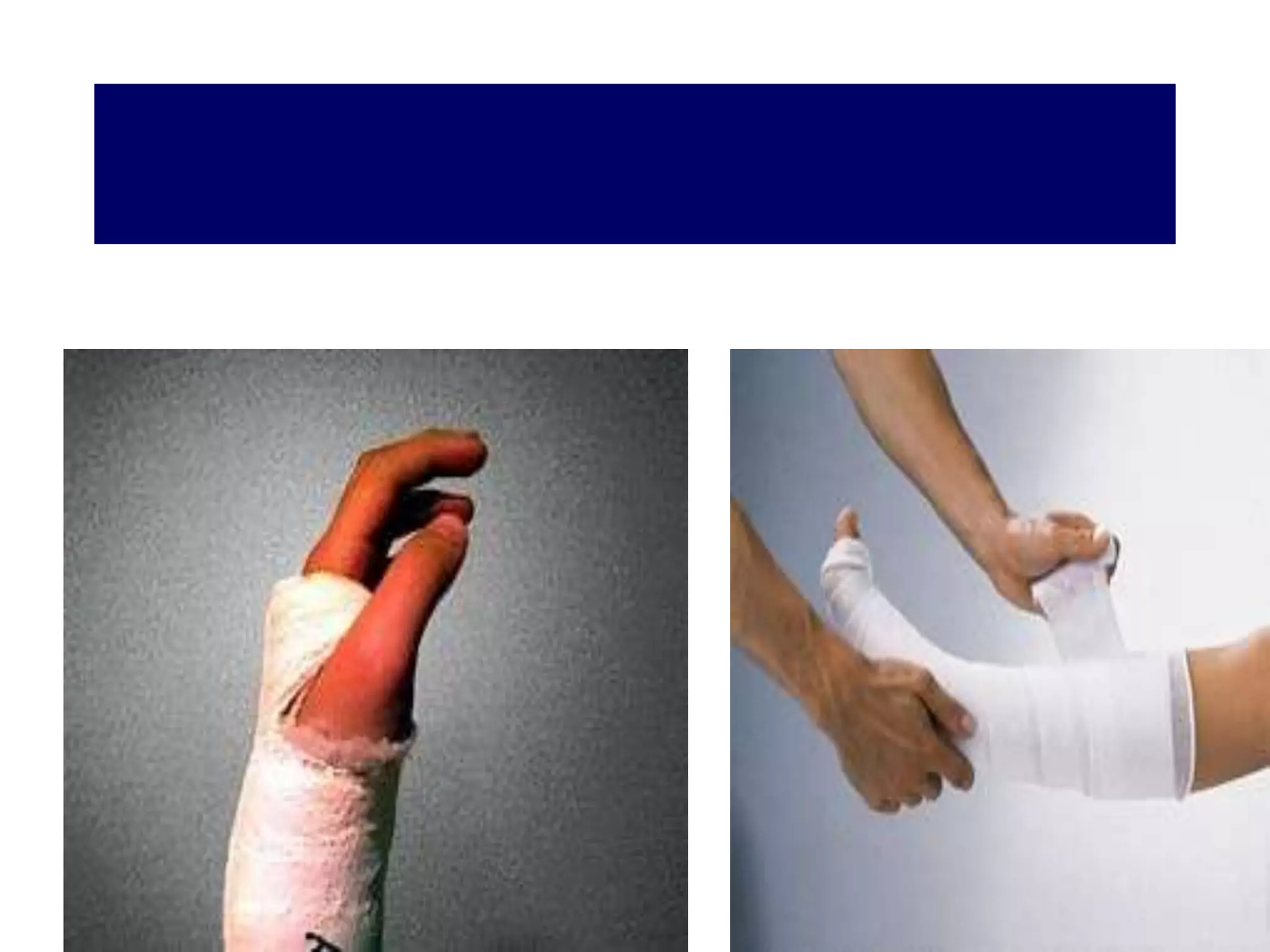 Plaster of Paris and Plaster Technique | PPTX