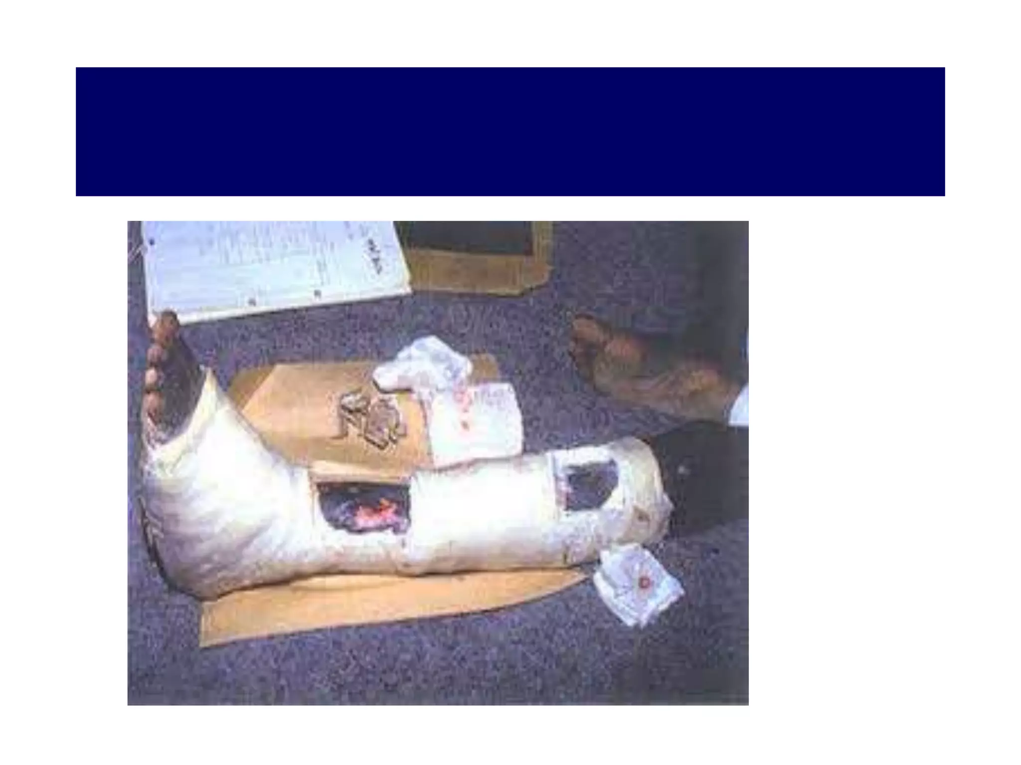 Plaster of Paris and Plaster Technique | PPTX