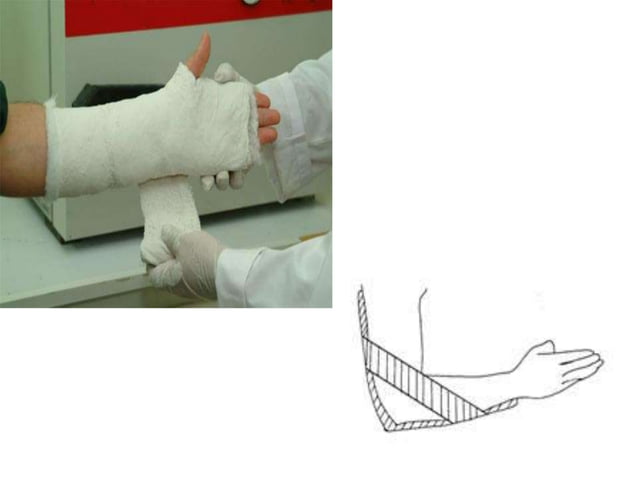 Plaster of Paris and Plaster Technique | PPTX