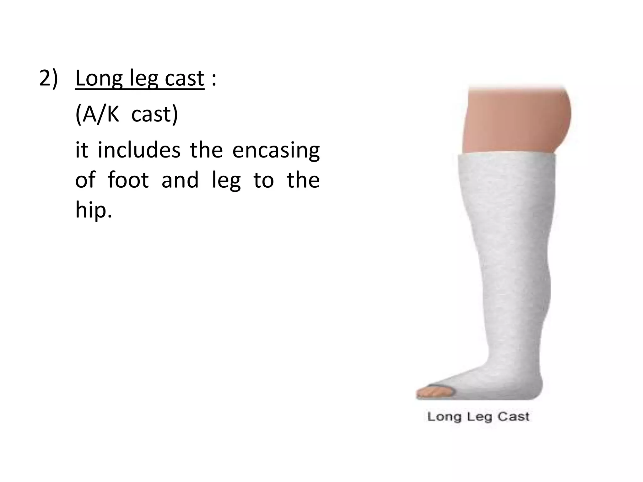 Plaster cast and its type | PPTX