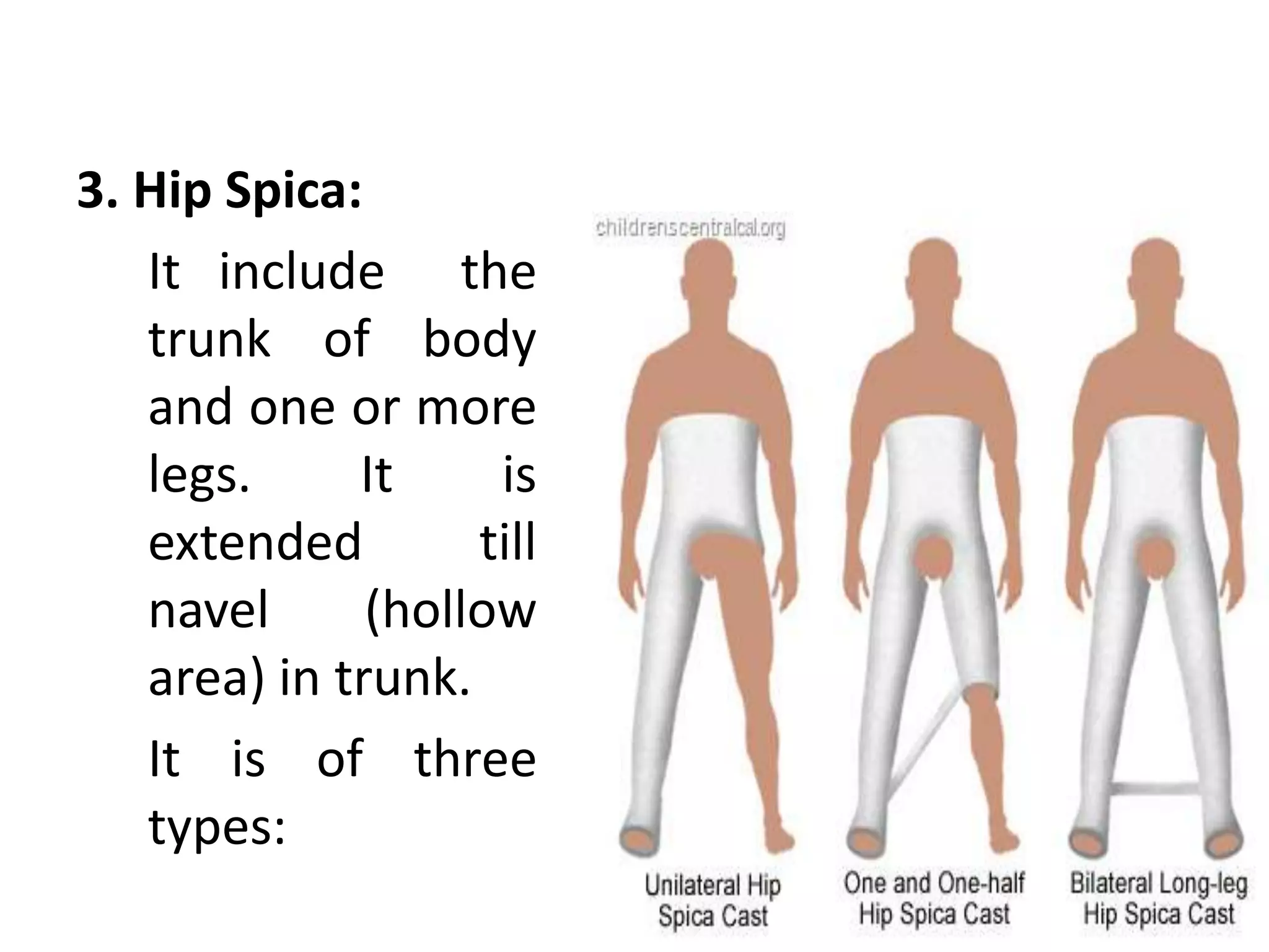 Plaster cast and its type | PPTX
