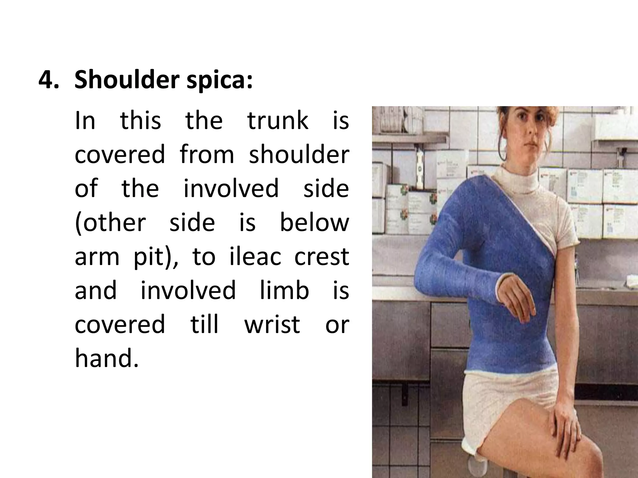 Plaster cast and its type | PPTX