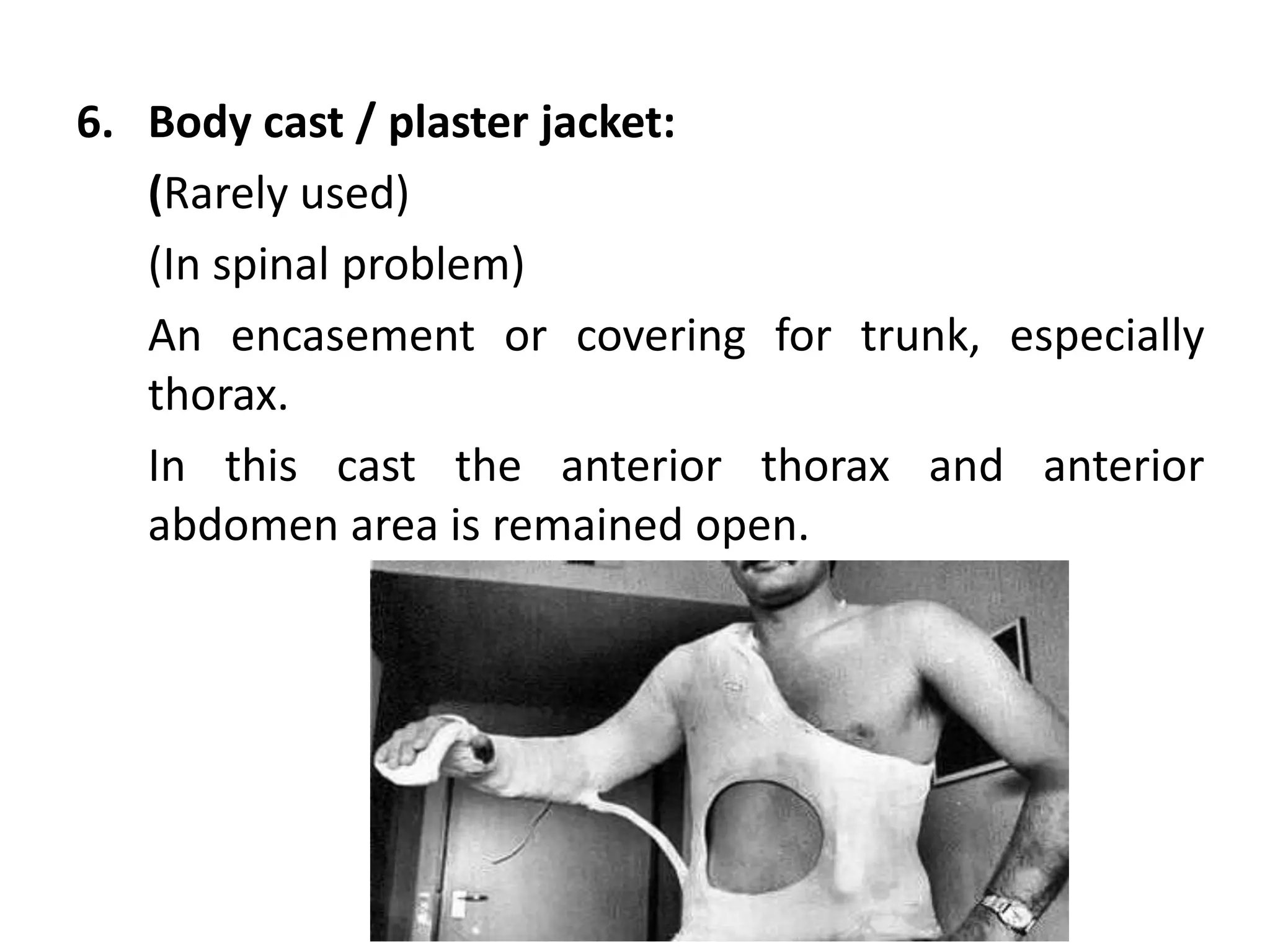 Plaster cast and its type | PPTX