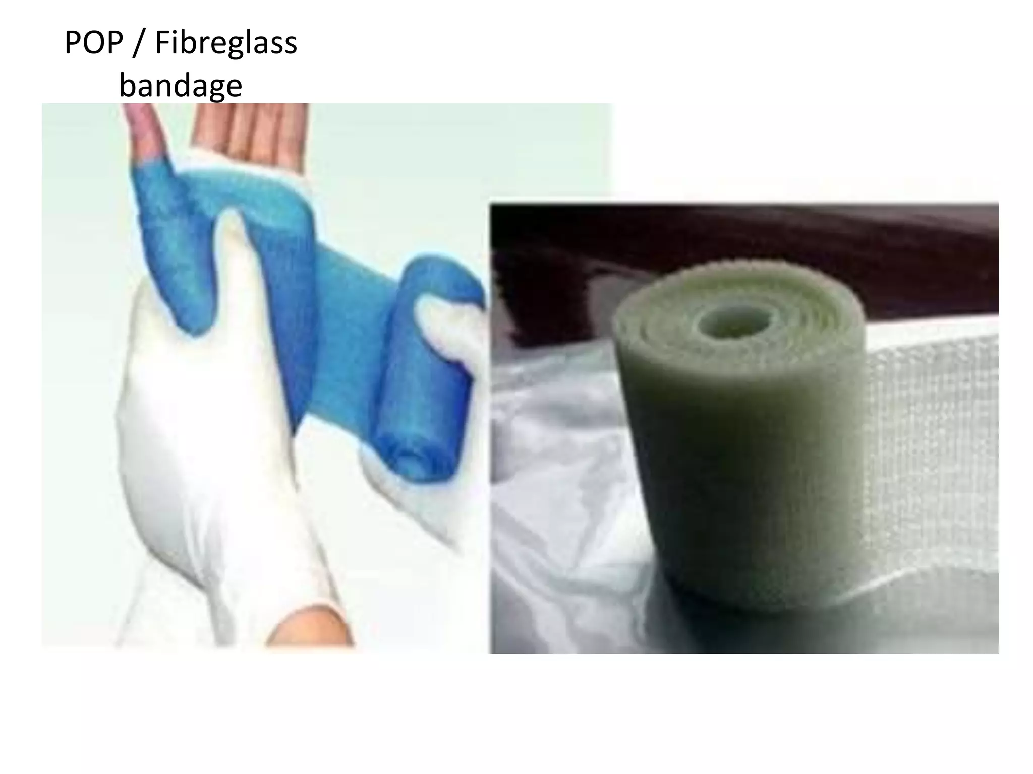 Plaster cast and its type | PPTX
