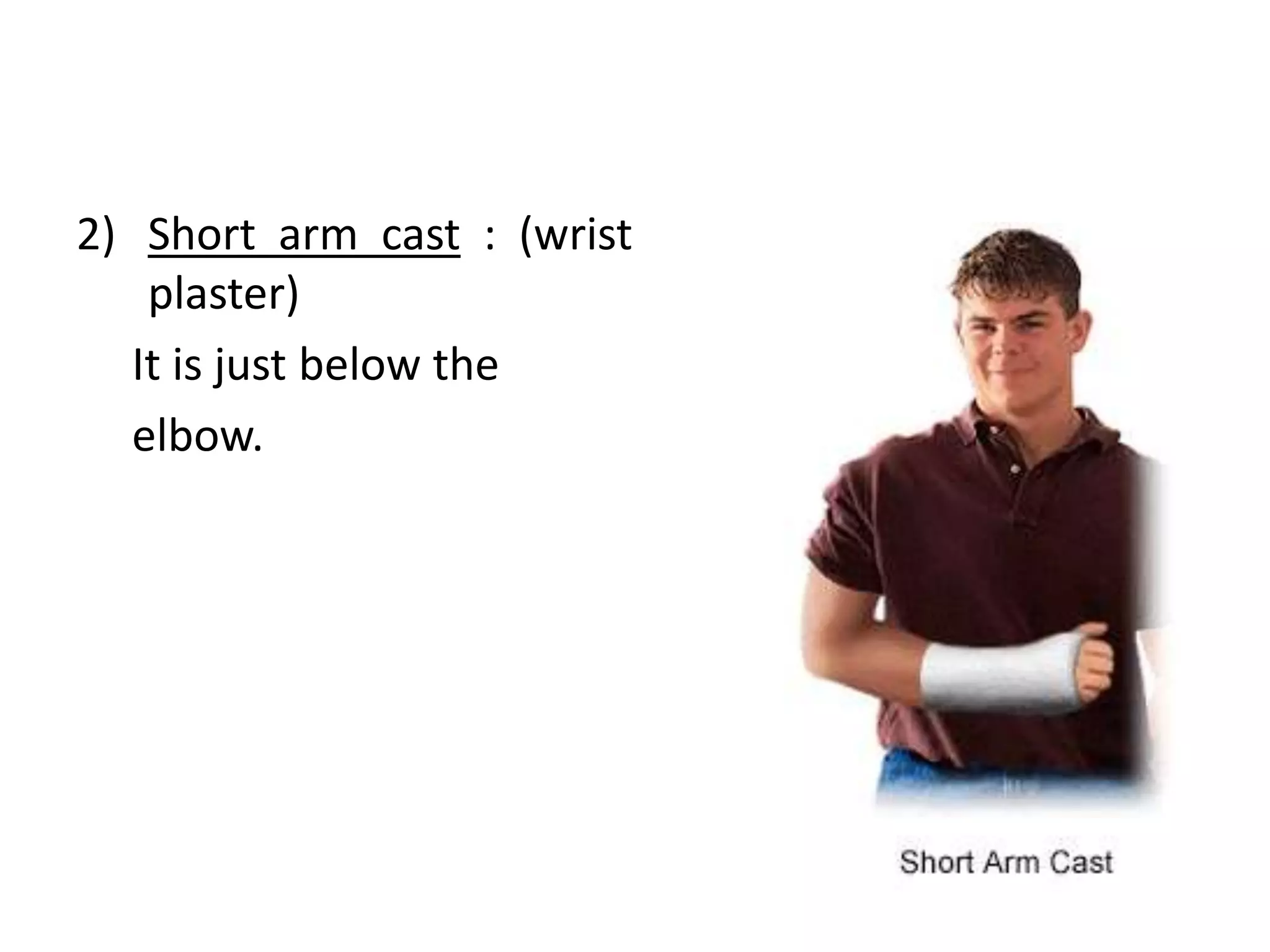 Plaster cast and its type | PPTX