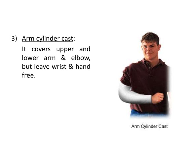 Plaster cast and its type | PPTX