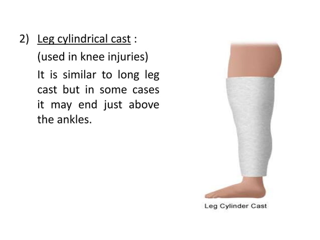 Plaster cast and its type | PPTX