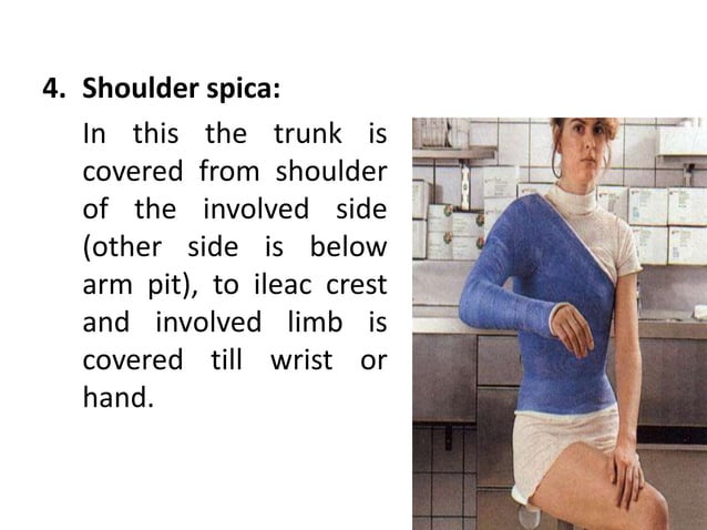 Plaster cast and its type | PPTX