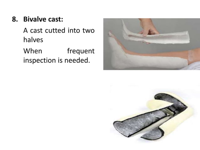 Plaster cast and its type | PPTX