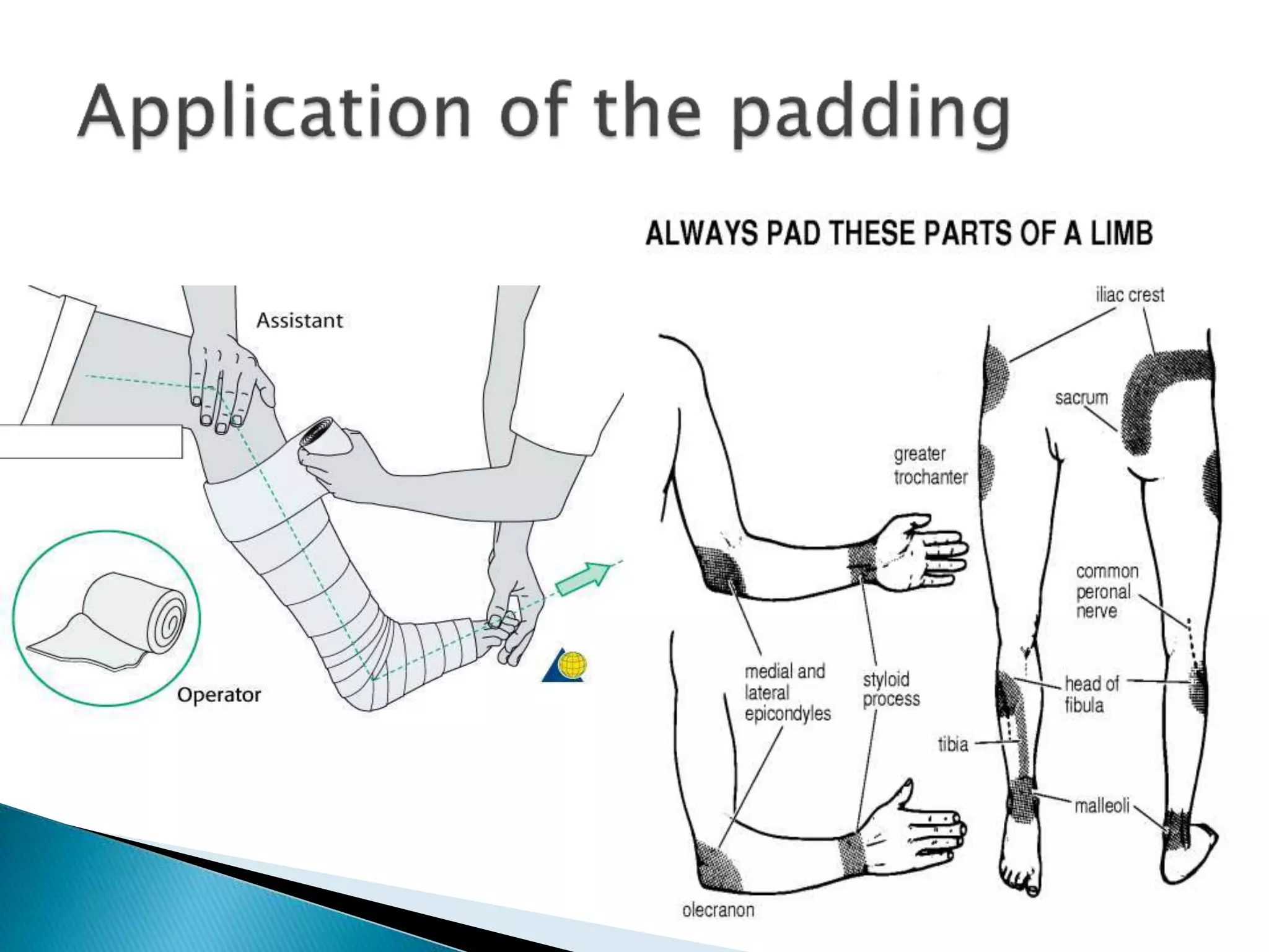 Plaster of paris ortho presentation | PPTX