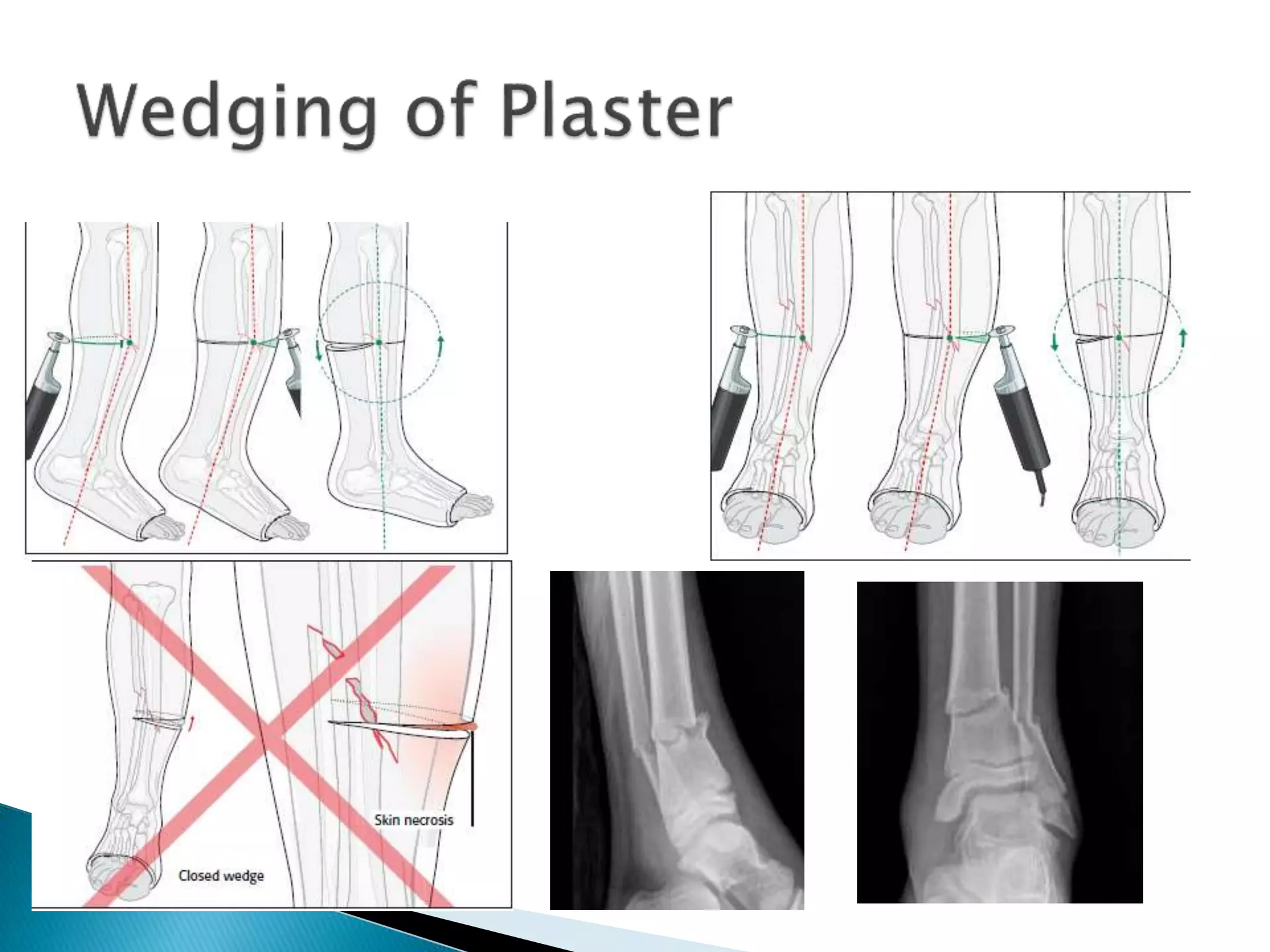 Plaster of paris ortho presentation | PPTX