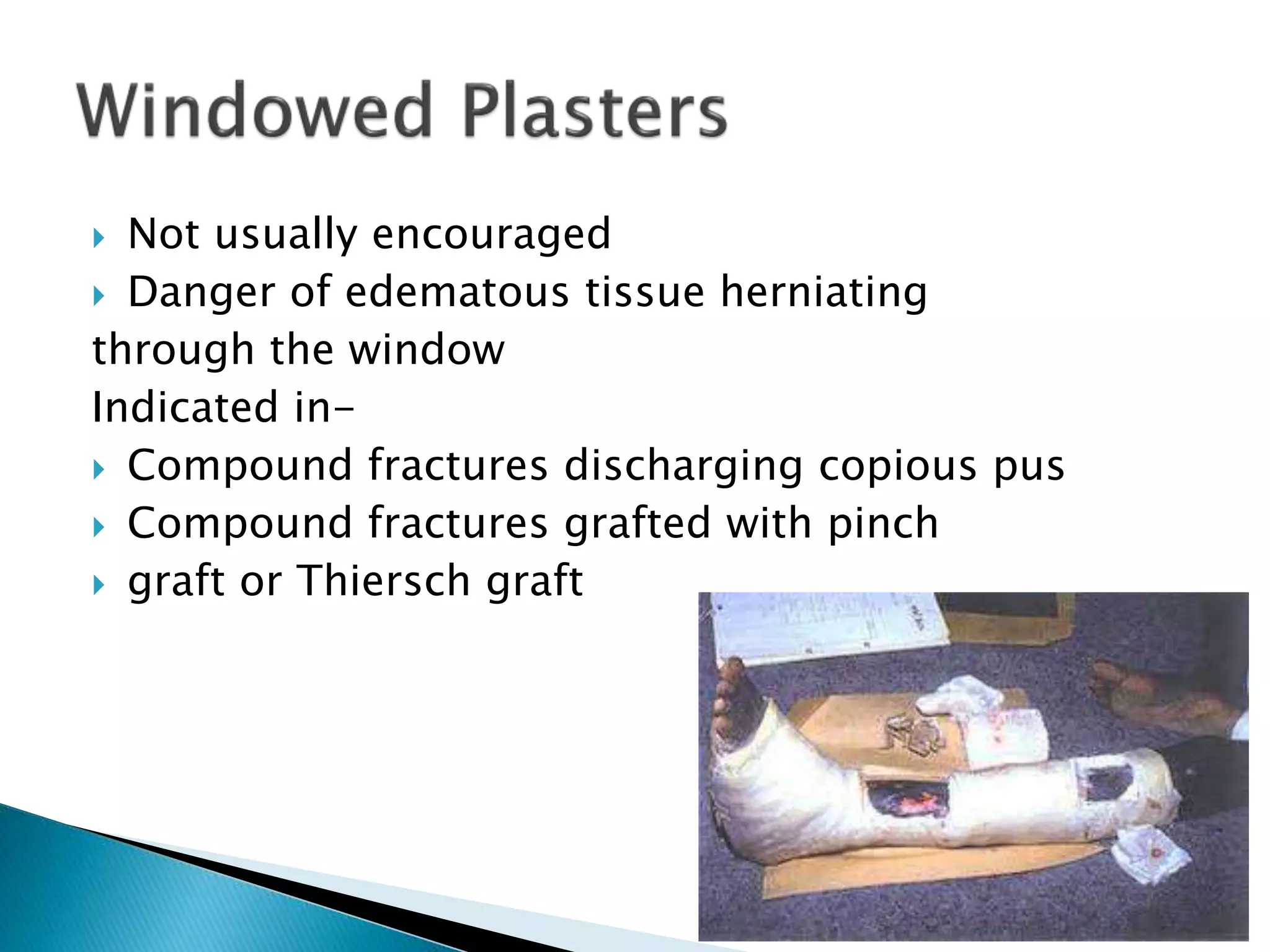 Plaster of paris ortho presentation | PPTX