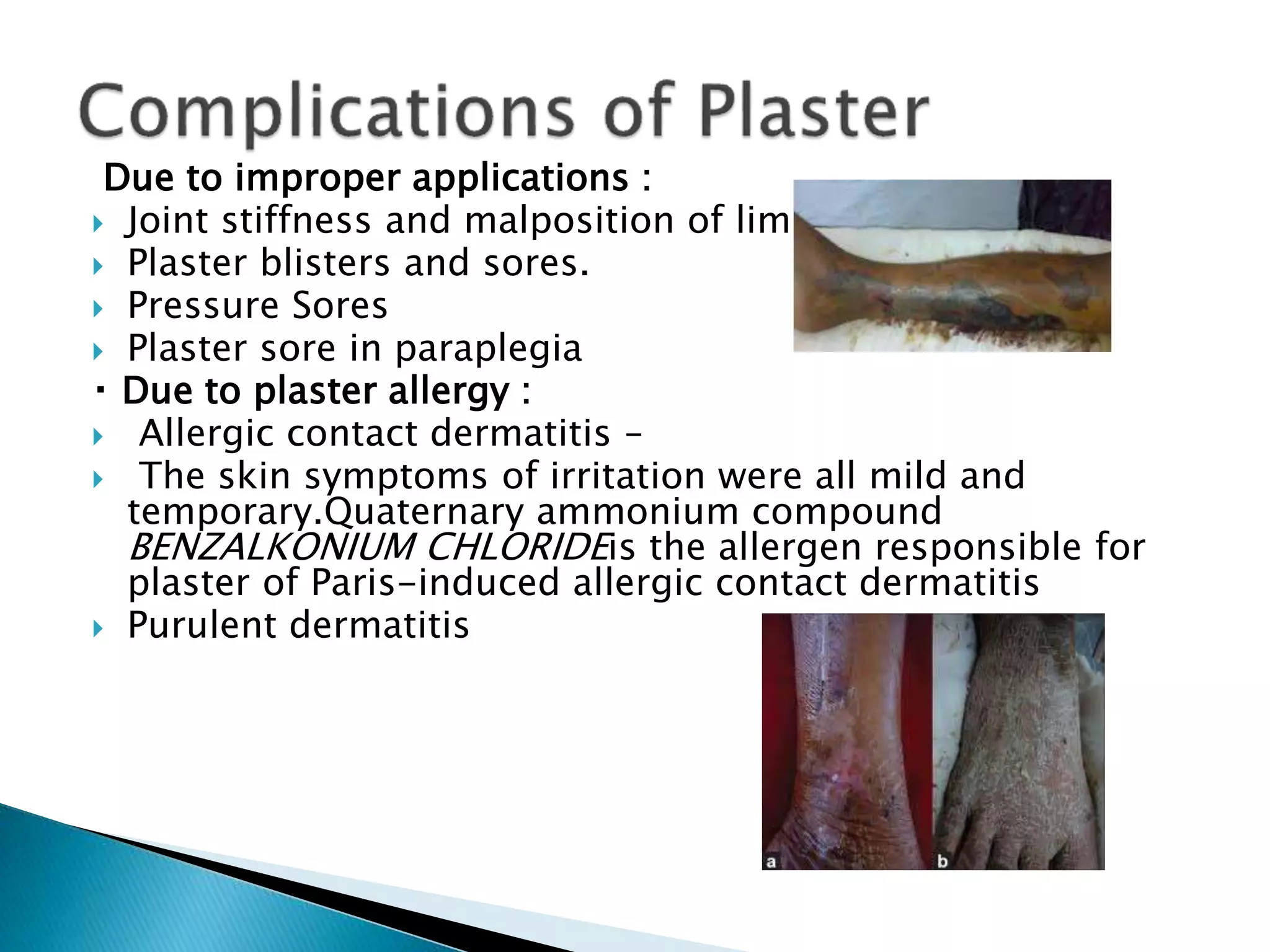Plaster of paris ortho presentation | PPTX