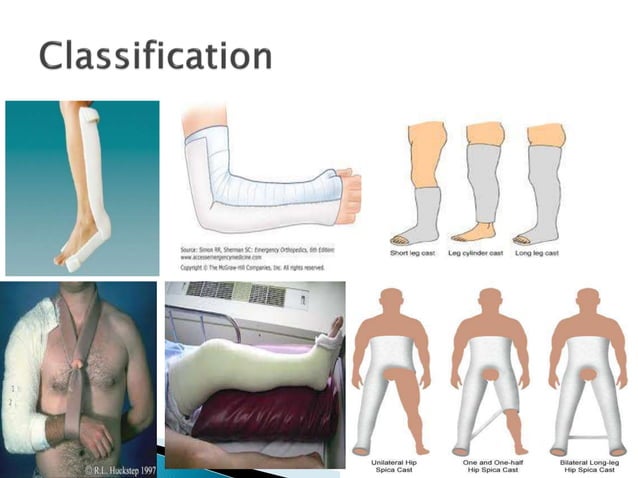 Plaster of paris ortho presentation | PPTX | Death, Injury, or Military ...