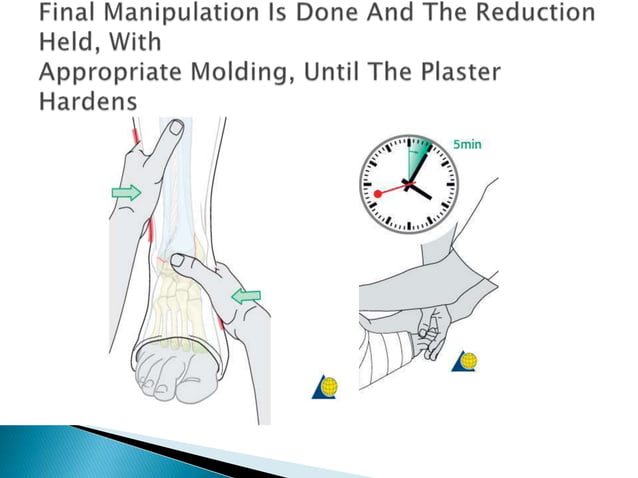 Plaster of paris ortho presentation | PPTX | Death, Injury, or Military ...