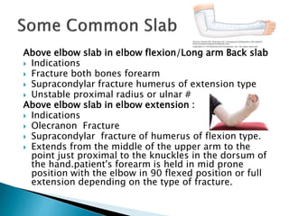 Colles Fracture Backslab