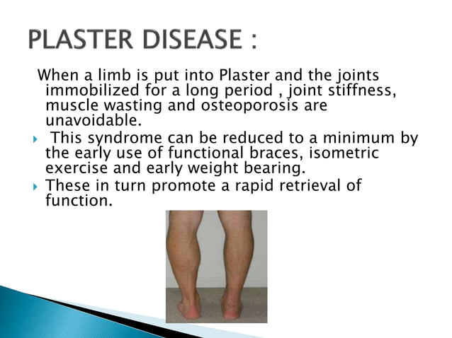 Plaster Of Paris Ortho Presentation Ppt