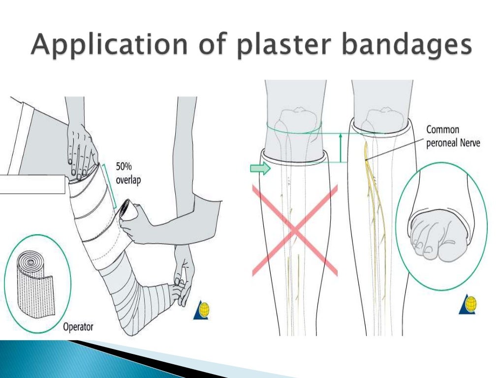Plaster of paris ortho presentation