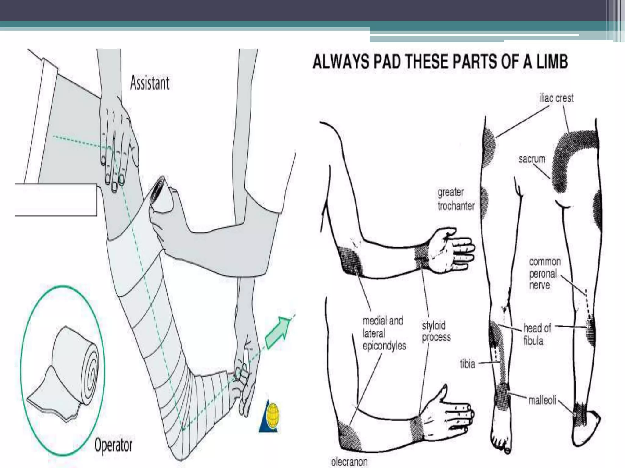 Plaster of paris ,synthetic casts and Functional cast bracing | PPTX